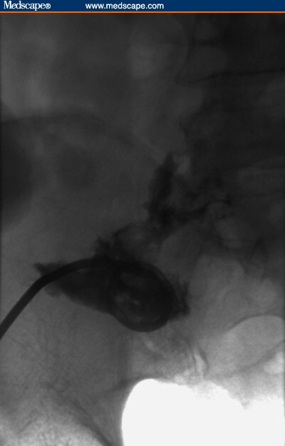 Perforation of the Colon Presenting as Abdominal Pain and Sepsis - Page 3