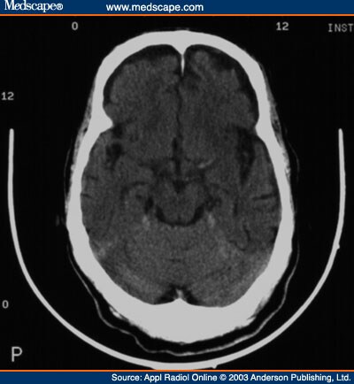 Acute-Onset-Right-Sided Weakness