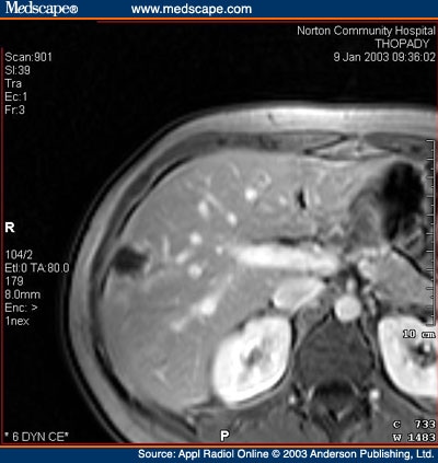 Multiple Hepatic Masses