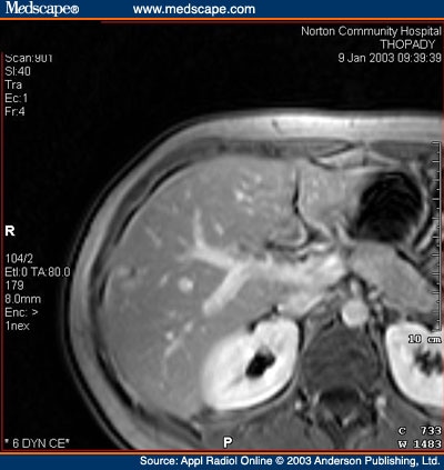 Multiple Hepatic Masses