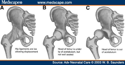 Detecting Developmental Dysplasia of the Hip - Page 2