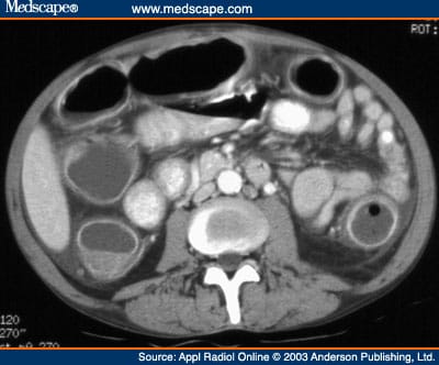 Abdominal Pain and Diarrhea