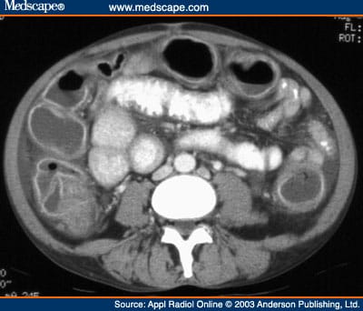 Abdominal Pain and Diarrhea