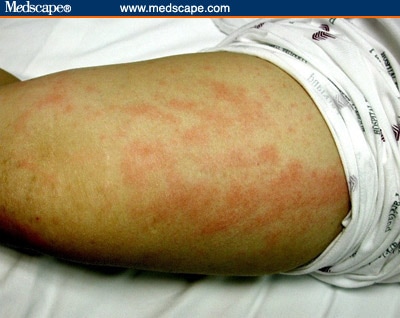 Evanescent Maculopapular Eruption With Fever and Joint Aches