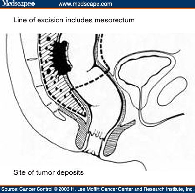 Total Mesorectal Excision in the Management of Rectal Cancer