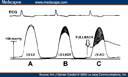 Management of the Elderly Aortic Stenosis Patient - Page 2