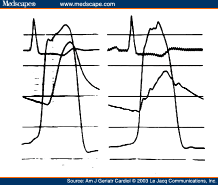 Management of the Elderly Aortic Stenosis Patient - Page 2