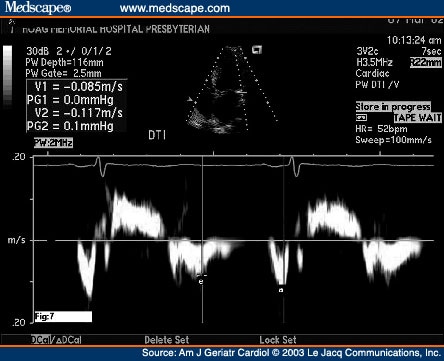 Diagnosis of Aortic Stenosis in the Elderly - Page 8