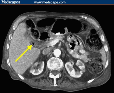 A 76-Year-Old Man Suffering From Urosepsis