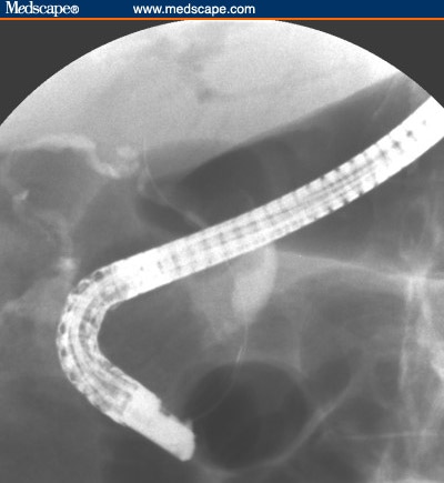 A 76-Year-Old Man Suffering From Urosepsis