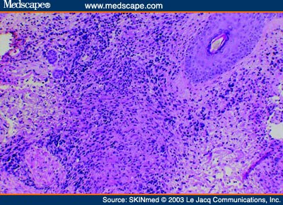 Intractable Cellulitis and a Solitary Pulmonary Nodule - Page 2