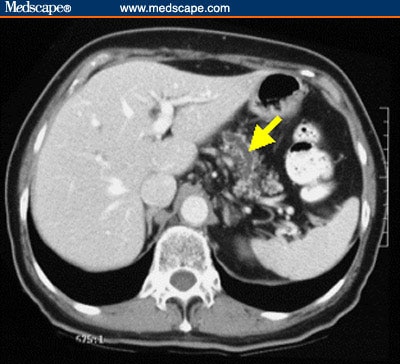 Unusual Finding in Pancreas Divisum and Abdominal Pain