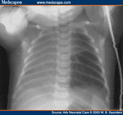 A Case Series of Five Infants with Scimitar Syndrome - Page 2