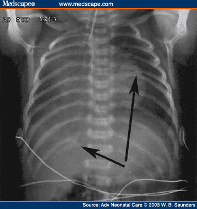 A Case Series of Five Infants with Scimitar Syndrome - Page 2