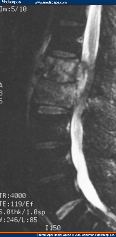 Abdominal Distention