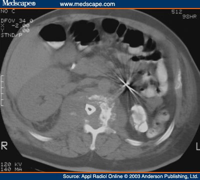 Abdominal Distention