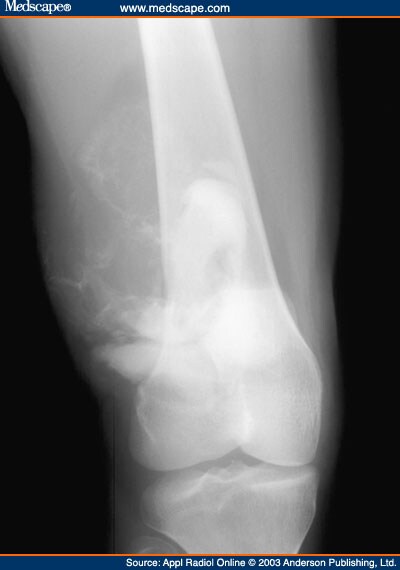 Pain and Palpable Mass