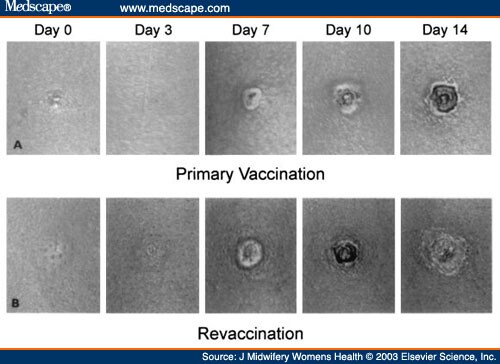 Smallpox: A Disease of the Past? - Page 8