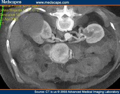 Evaluation of a Pancreatic Mass