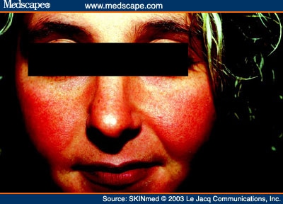 Persistent Erythema, Telangiectases, and Facial Flushing