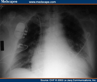 Pacing Techniques in HF: Current Concepts and Future Outlook - Page 5