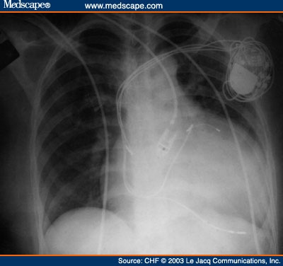 Pacing Techniques in HF: Current Concepts and Future Outlook - Page 5