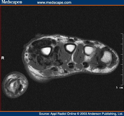 Painless Mass in the Hand
