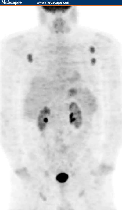 PET Case Cavalcade, Case XI: Axillary Lymphadenopathy