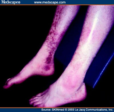 Polyarteritis Nodosa and Cutaneous Polyarteritis Nodosa - Page 2