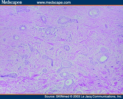 Multiple Syringomas in an Unusual Distribution