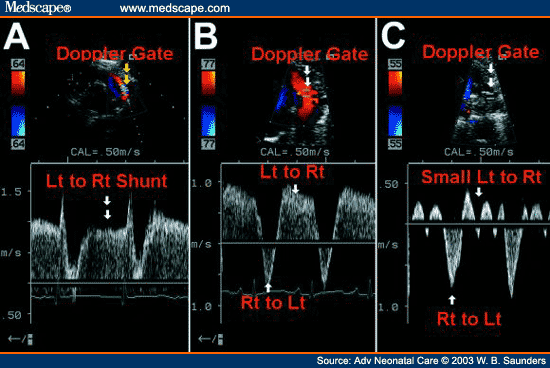 Patent Ductus Arteriosus in Preterm Infants - Page 4