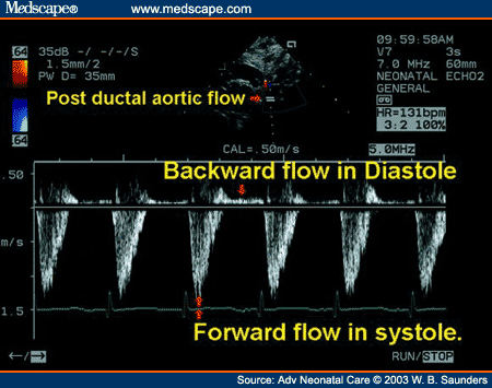Patent Ductus Arteriosus in Preterm Infants - Page 4