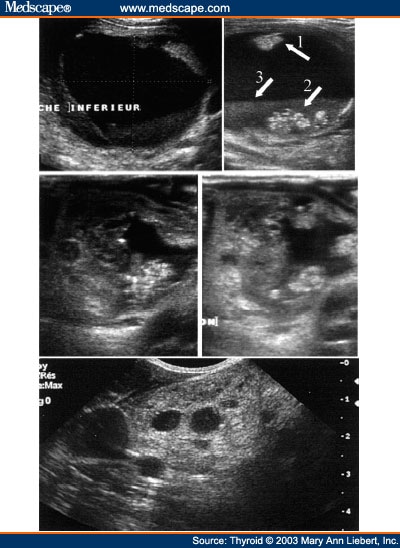 Acute Increase in Goiter Size During a Normal Pregnancy - Page 2