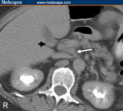 PET Case Cavalcade, Case XIII: Postop Oncology Patients
