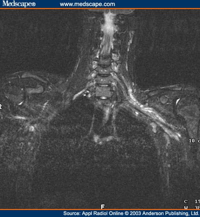 Deltoid Muscle Atrophy