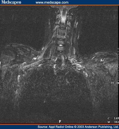 Deltoid Muscle Atrophy