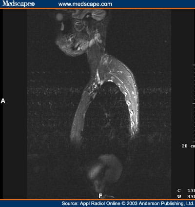 Deltoid Muscle Atrophy