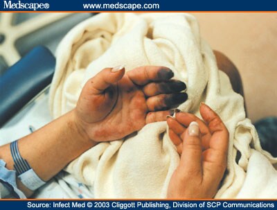 Septic Shock and Hemorrhagic Rash