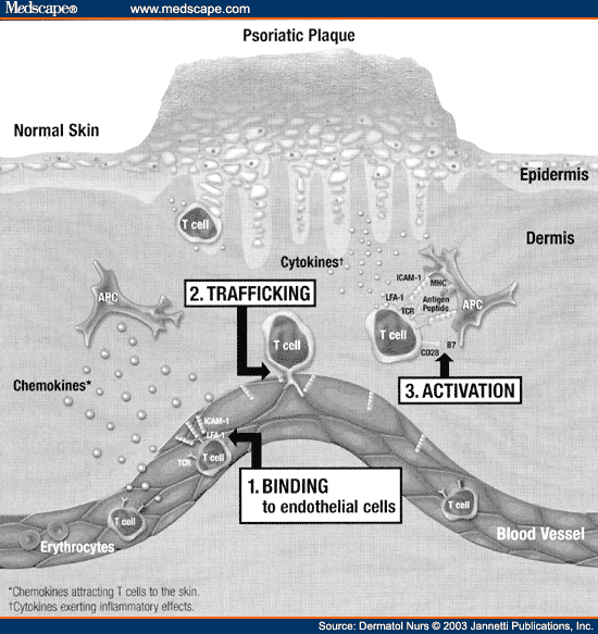 Preparing Dermatology Nurses: Biologic Therapy for Psoriasis - Page 3