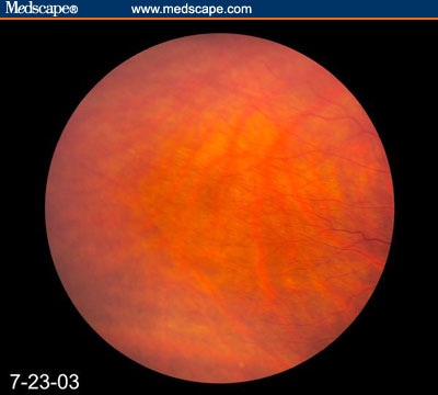 An Infant With a Retinal Fold - Page 2