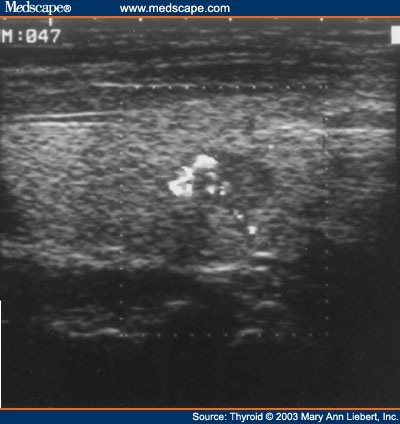 Ultrasound-Guided Laser Thermal Ablation and Goiter - Page 2