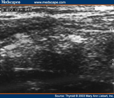 Ultrasound-Guided Laser Thermal Ablation and Goiter - Page 3