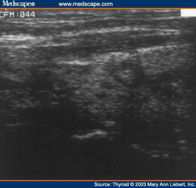 Ultrasound-Guided Laser Thermal Ablation and Goiter - Page 3