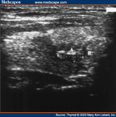 Ultrasound-Guided Laser Thermal Ablation and Goiter - Page 3