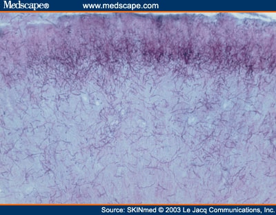 Mucous Aggregate of the Nasopharynx: The Mucolith