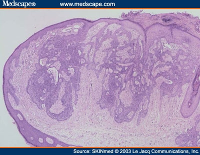 Fibroepithelioma of Pinkus Presenting as a Sessile Thigh Nodule