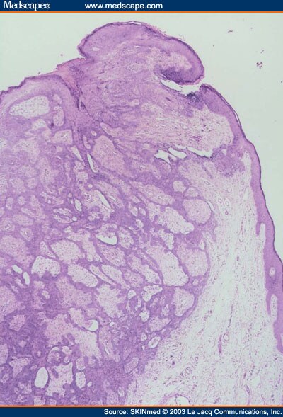 Fibroepithelioma of Pinkus Presenting as a Sessile Thigh Nodule