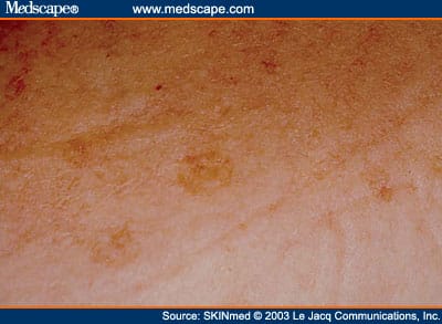 Disseminated Superficial Actinic Porokeratosis