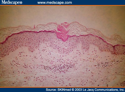 Disseminated Superficial Actinic Porokeratosis