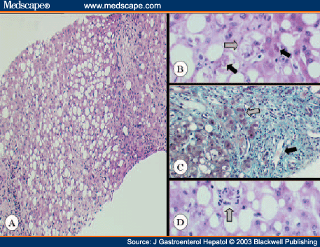 Pathogenesis and Management of Alcoholic Hepatitis - Page 6